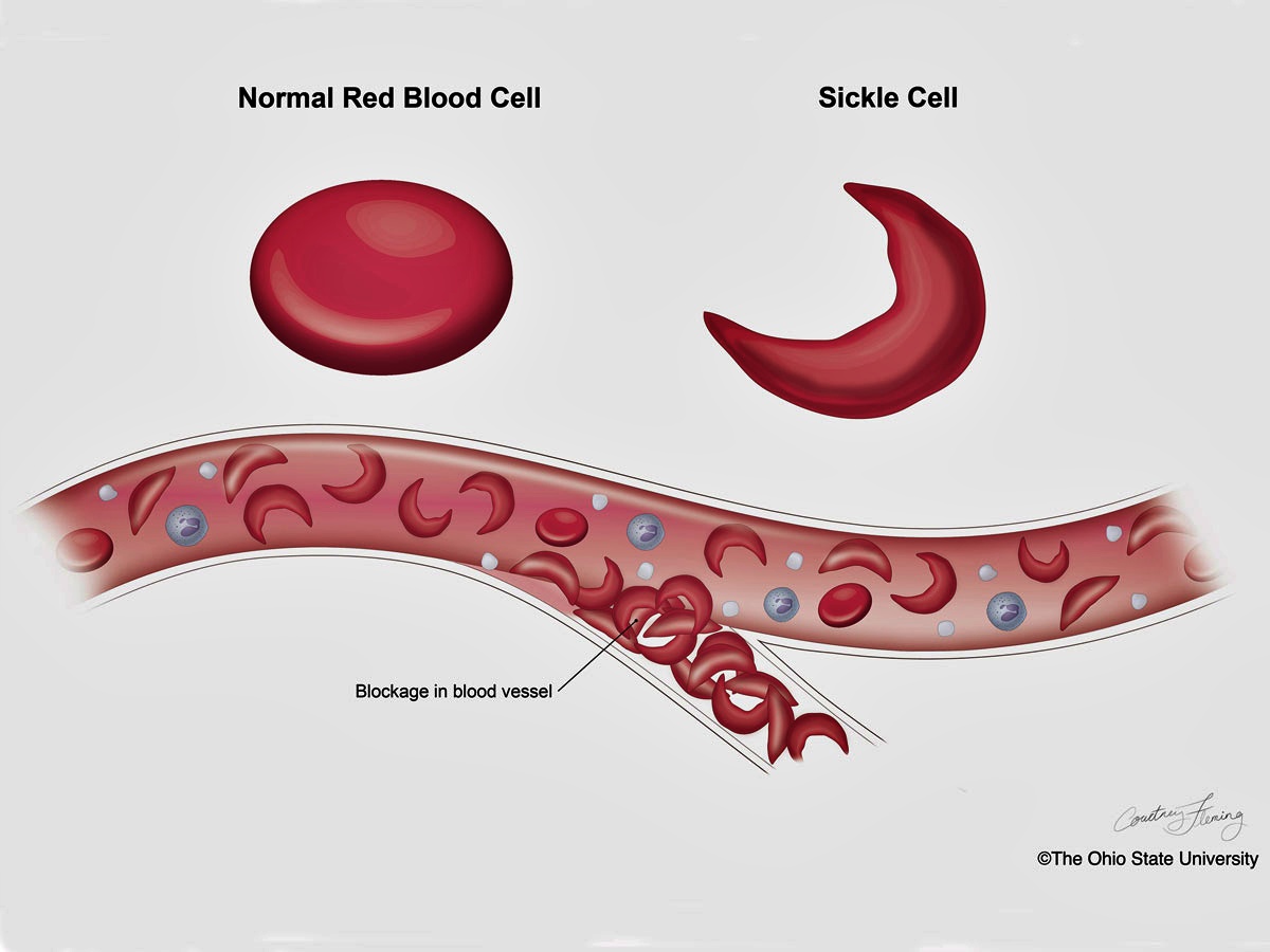 How Stem Cells Can Transform Sickle Cell Anaemia Treatment